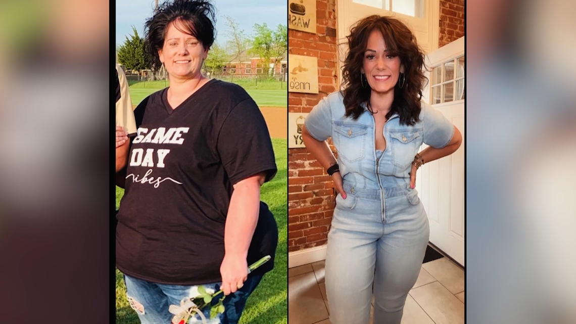 Houston surgeon sees surge in body lifts following GLP-1 weight loss ...