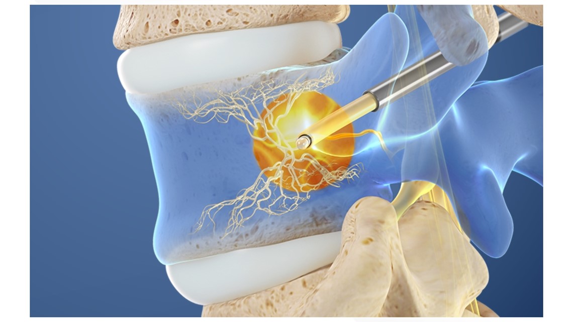 Spine | Intracept | krem.com
